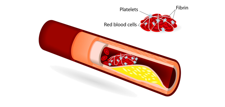 Blood clot symptoms and causes • Heart Research Institute